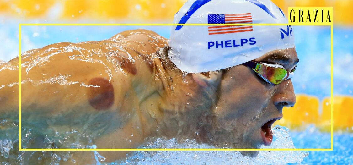 What Is The Cupping Therapy Everyone Is Talking About? | Grazia India